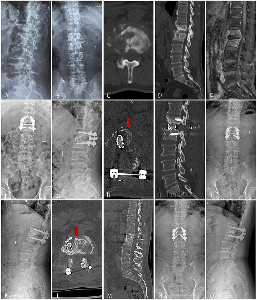 titanium in spine