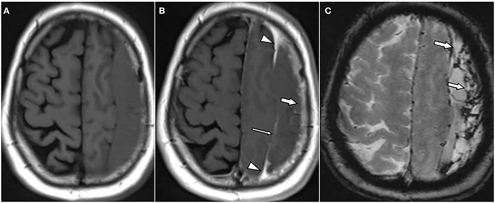 chronic subdural collection