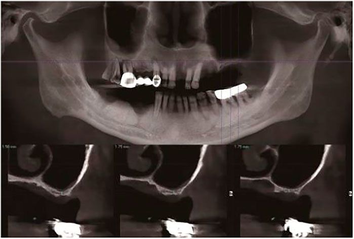short implants mandible