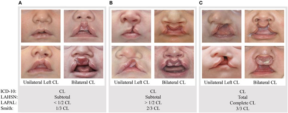 microform cleft lip causes