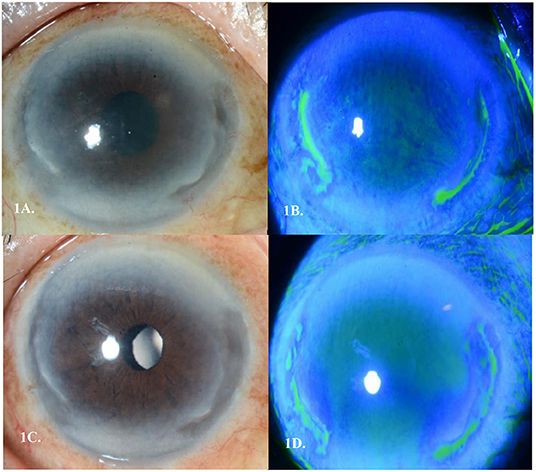 peripheral ulcerative keratitis