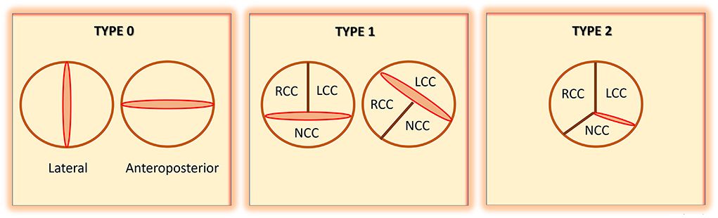 bicuspid valve type
