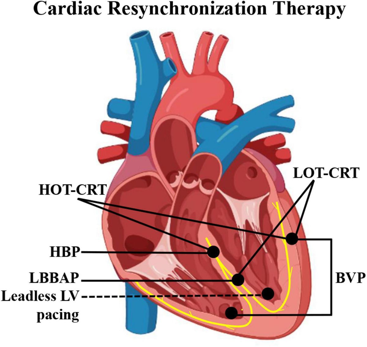 cardiac resynchronisation therapy