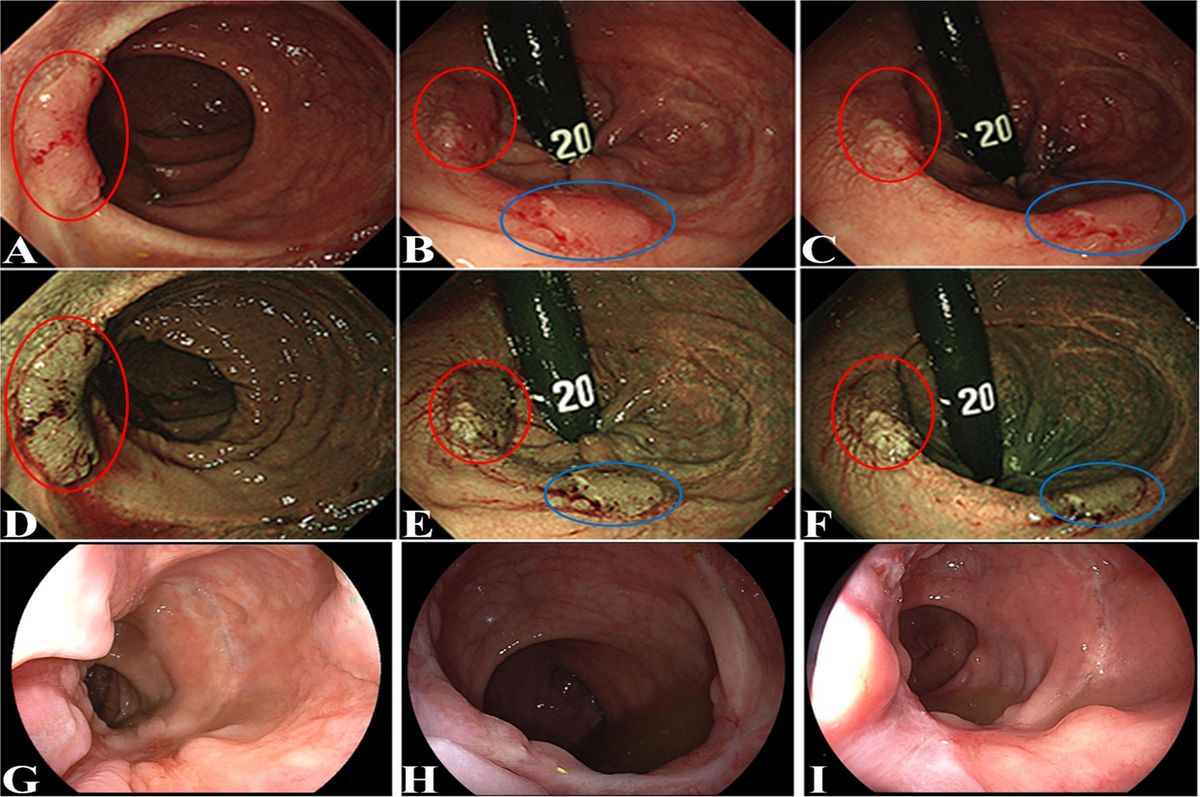 ascending colon malignancy