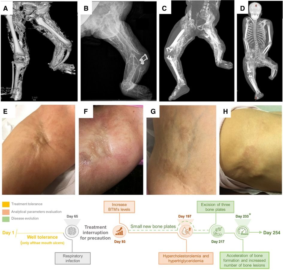 abnormal new bone formation