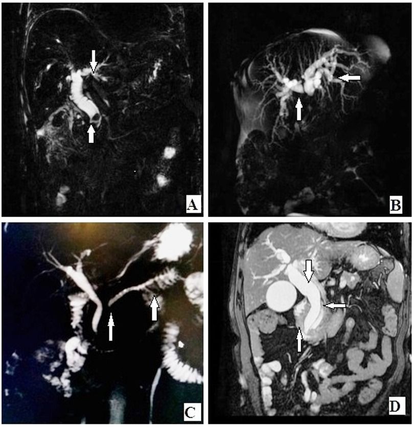 choledocholithiasis mrcp