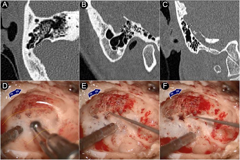 sigmoid sinus diverticulum