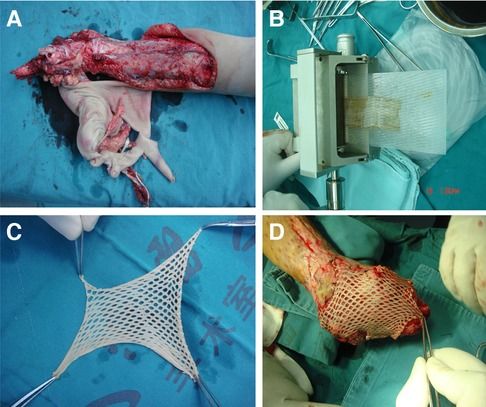 avulsion wound example