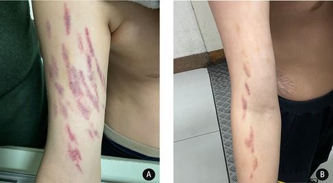 single petechiae on arm