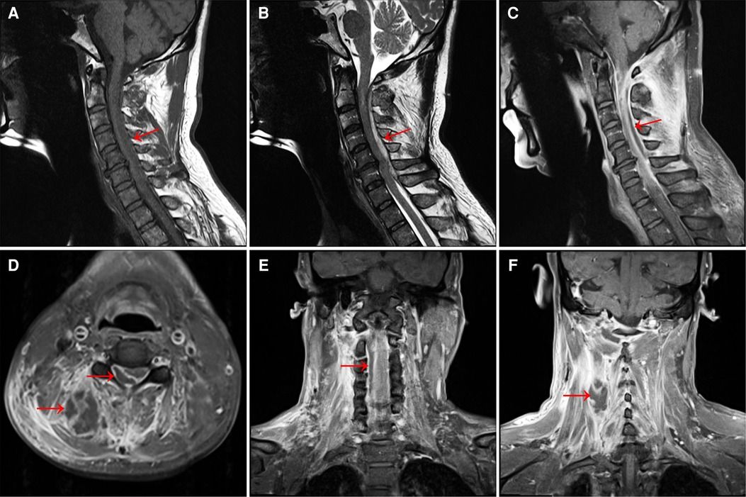epidural abscess