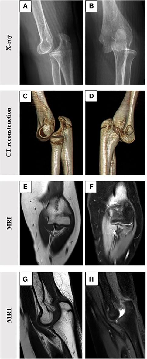 coronoid process of ulna x ray