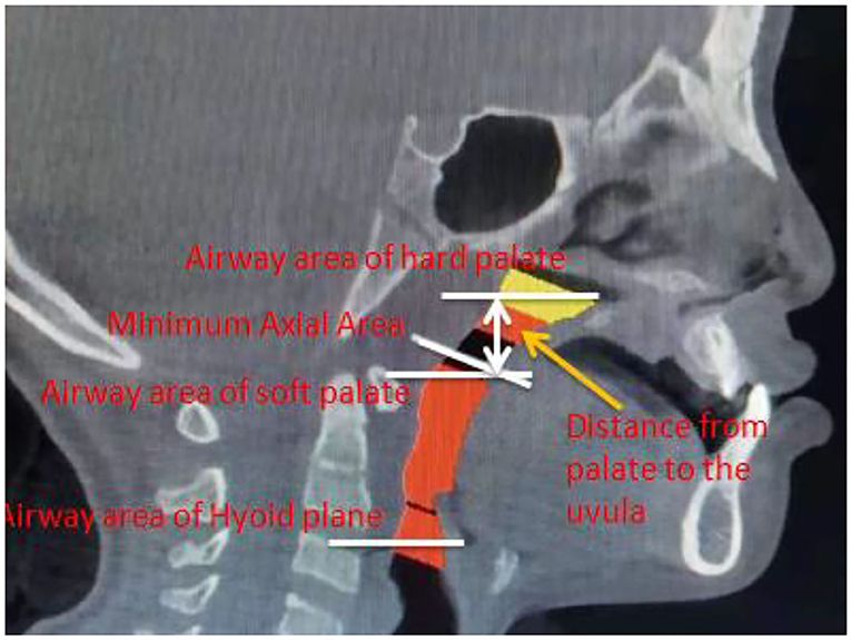 normal hard palate ct