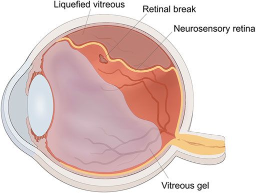 what is vitreous gel