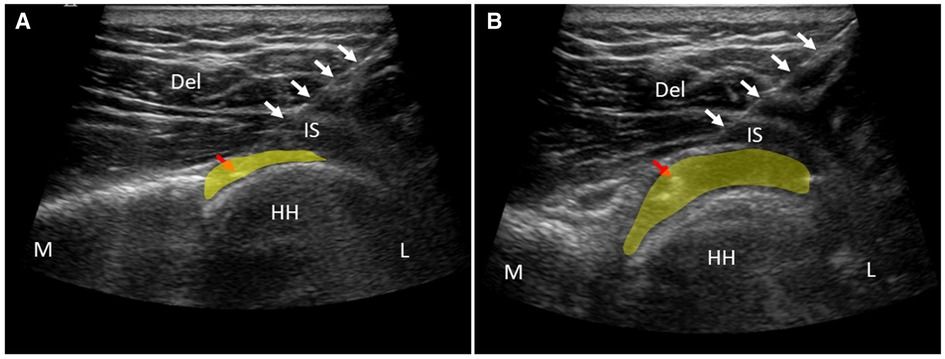 subcoracoid bursitis injection
