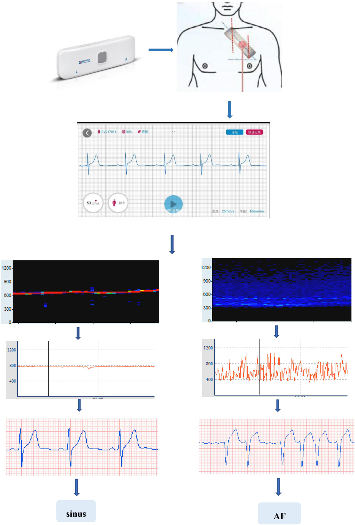 Frontiers | Long-term single-lead electrocardiogram monitoring to ...