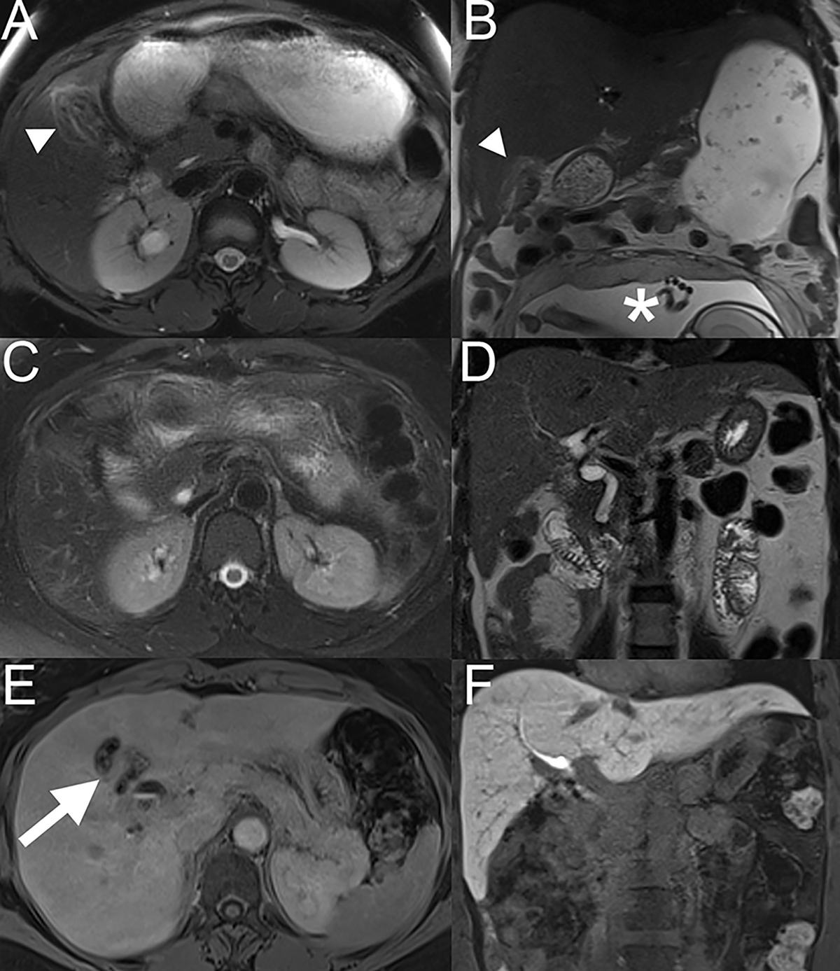 Frontiers | Gallbladder cancer during pregnancy treated with surgery ...