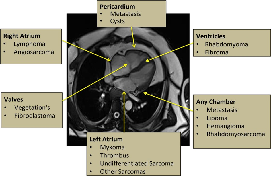 Frontiers | Tissue characterization of benign cardiac tumors by cardiac ...