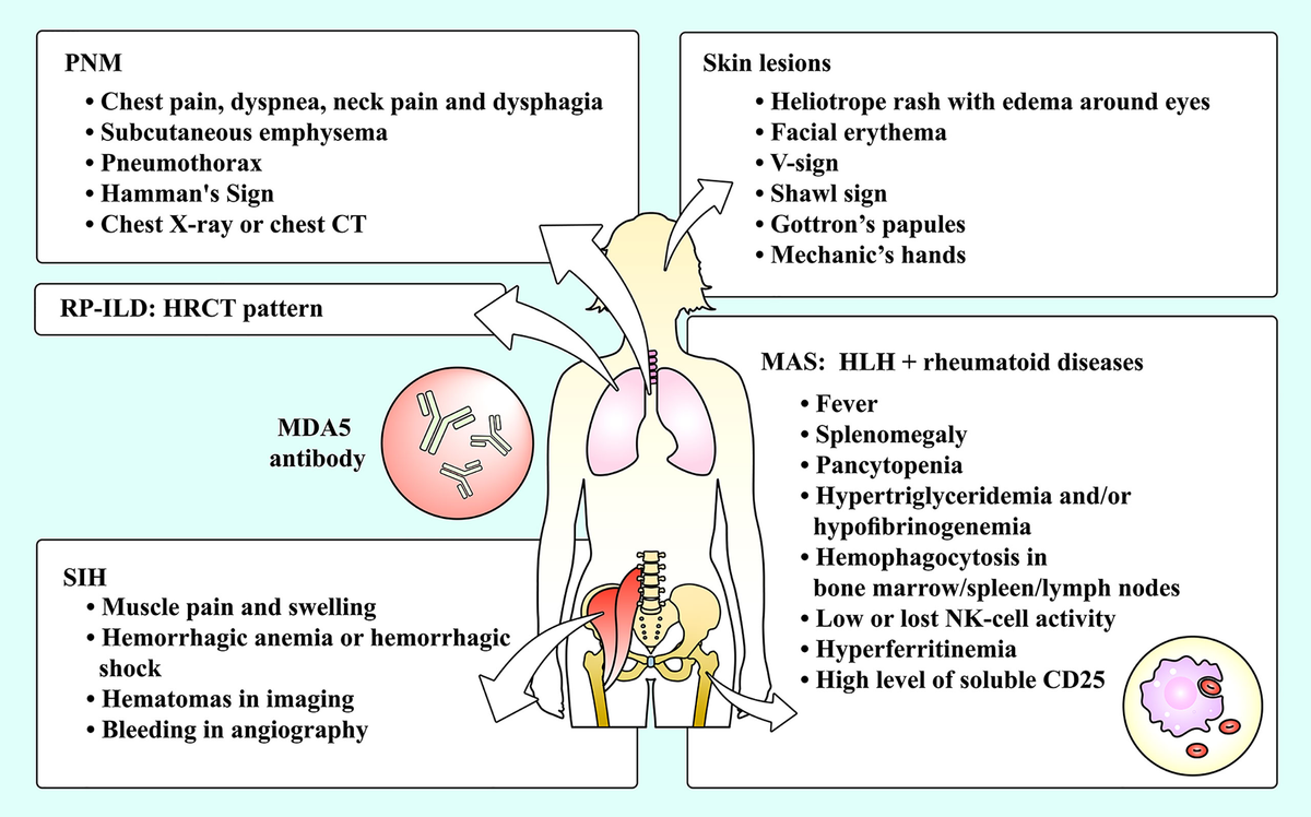 Frontiers | Rare complications of anti-melanoma differentiation ...