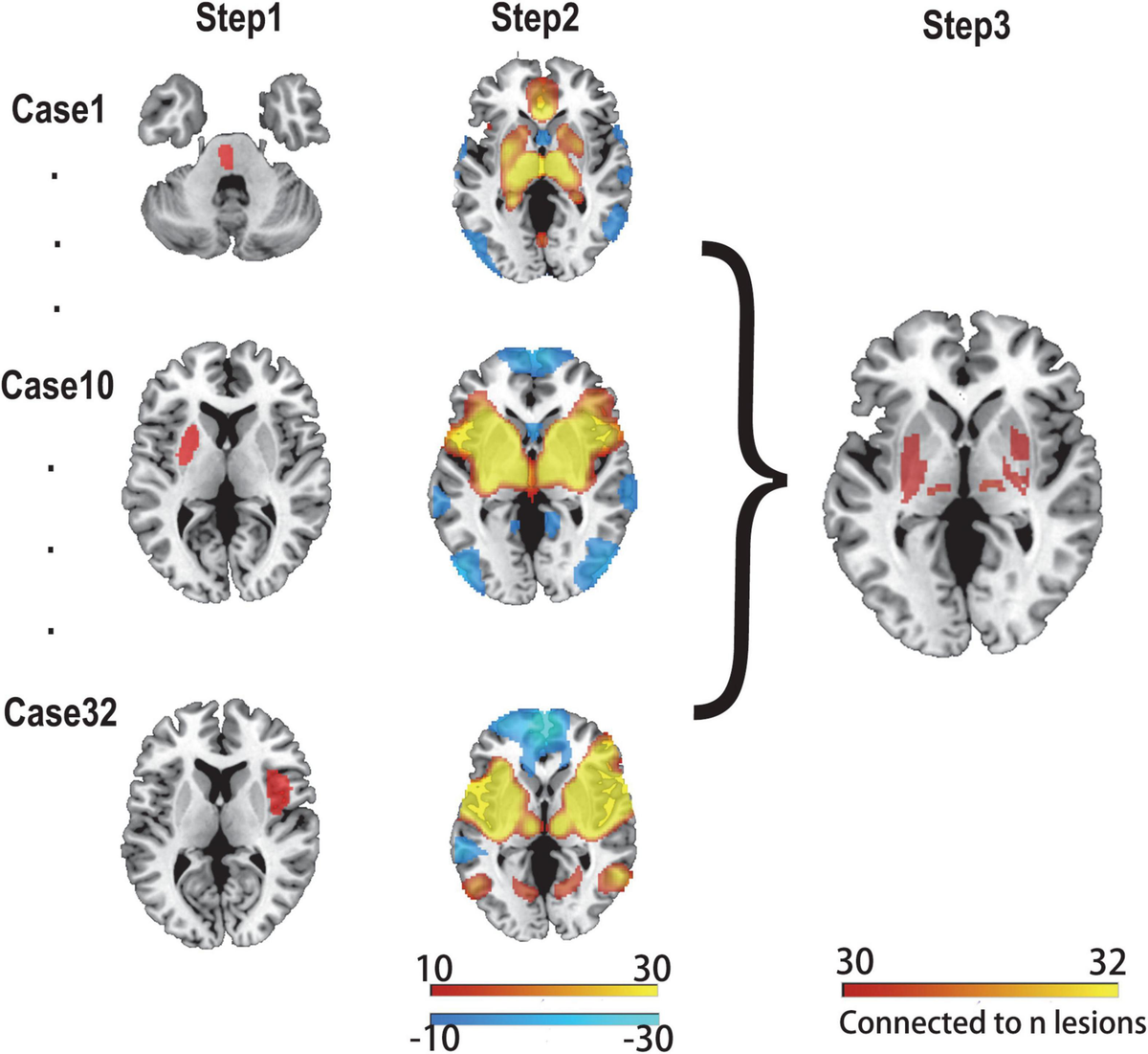 Frontiers | Lesions causing post-stroke spasticity localize to a common ...