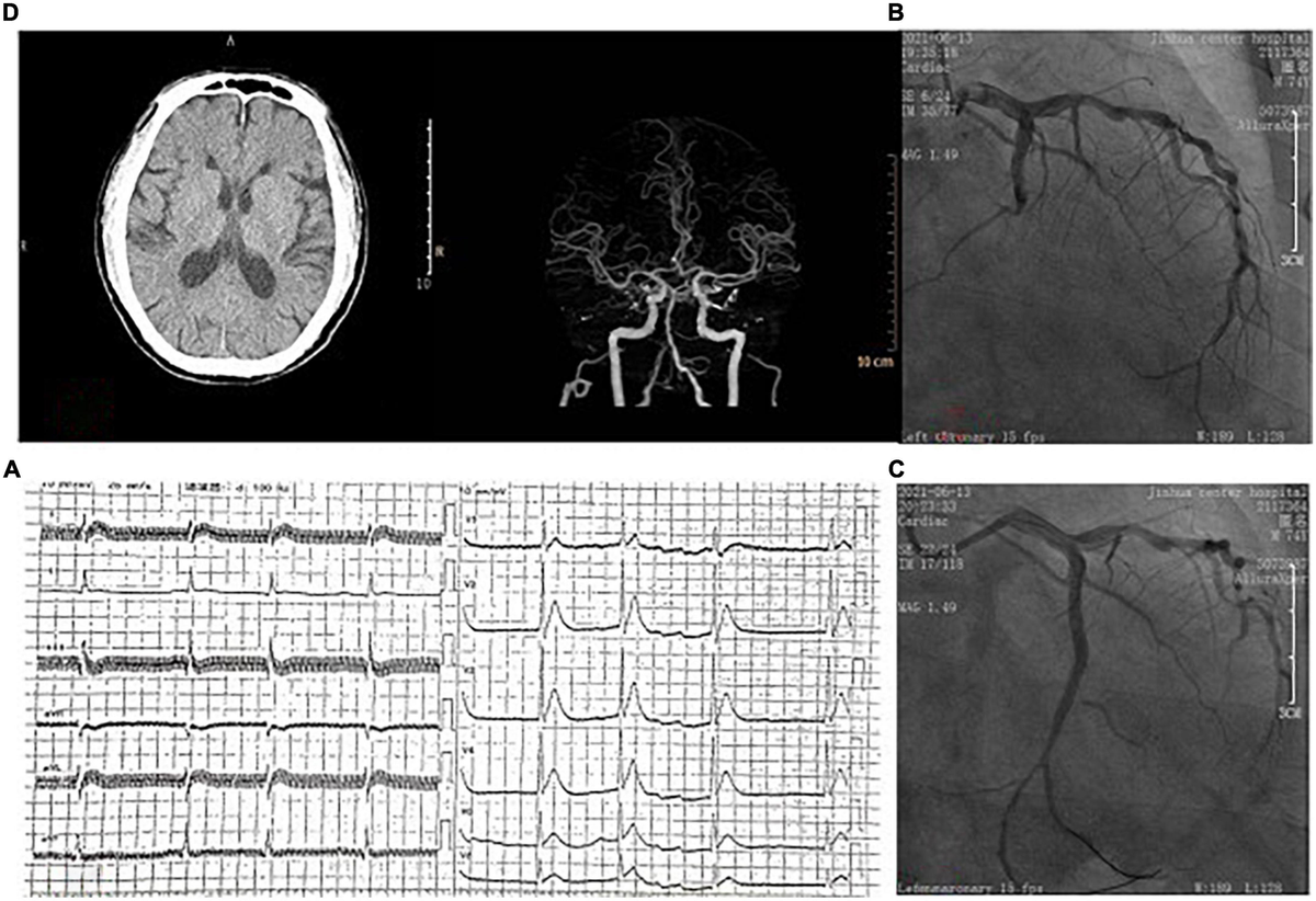 Frontiers | Concurrent acute myocardial infarction and acute ischemic ...