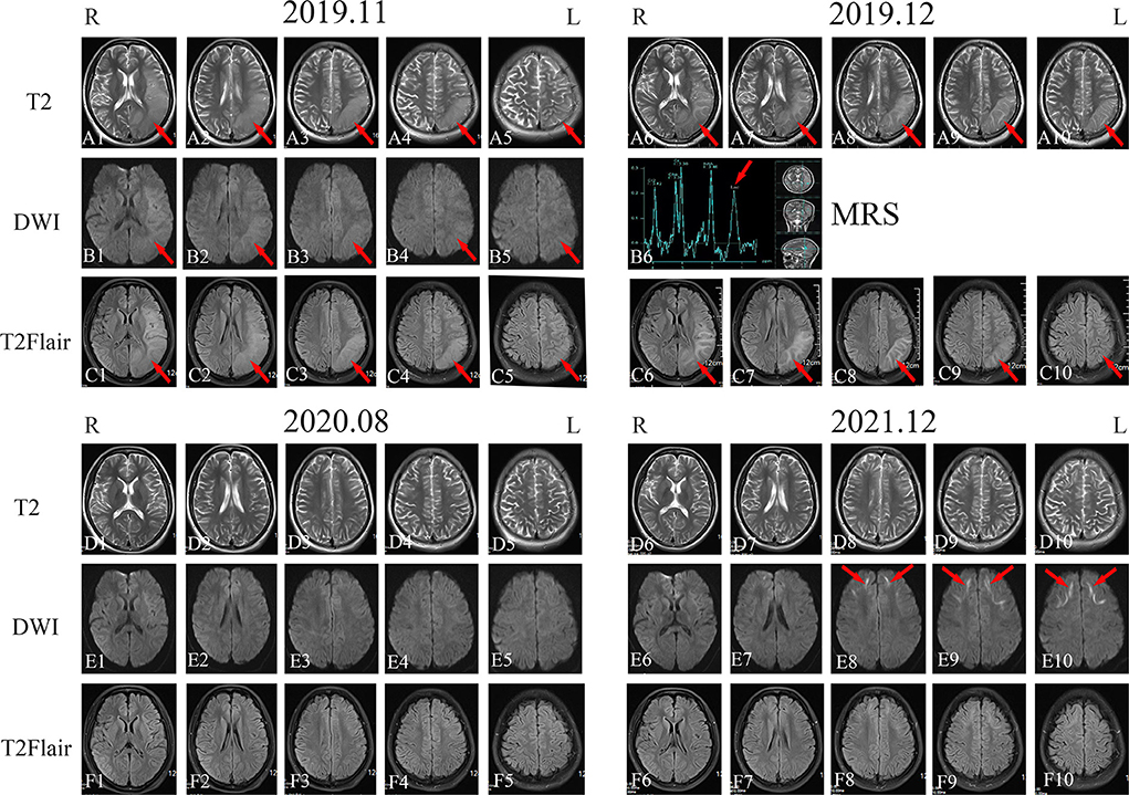 Frontiers | Case report: Two siblings with neuronal intranuclear ...