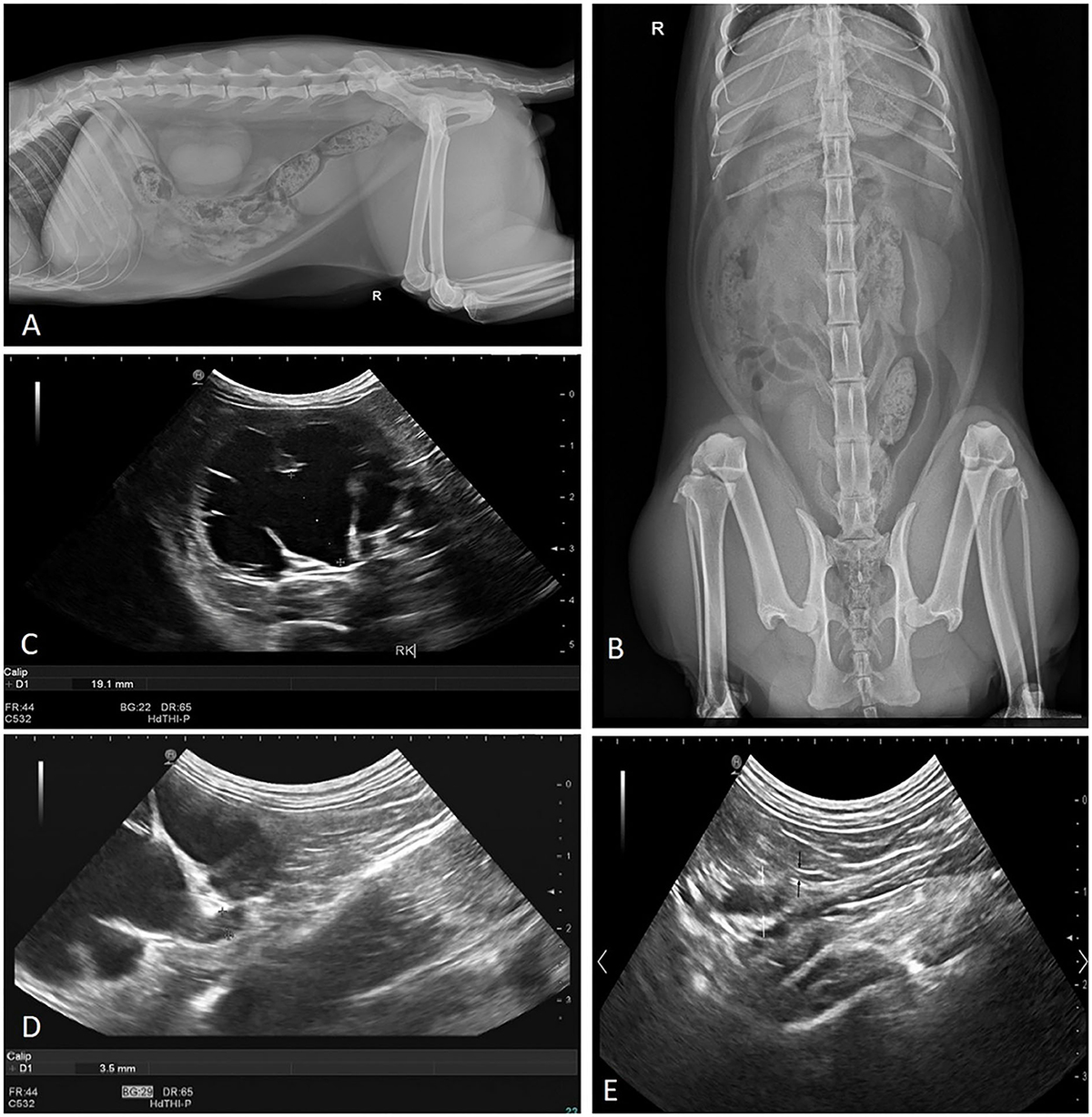 Frontiers | Antegrade CT pyelography of right retrocaval ureter causing ...