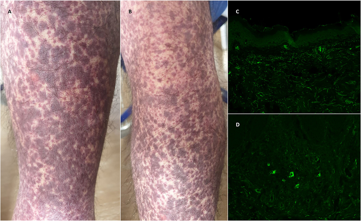 Frontiers | Cutaneous vasculitis: Lessons from COVID-19 and COVID-19 vaccination