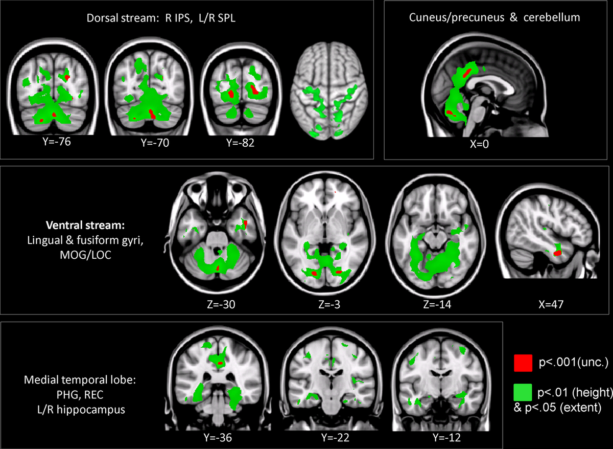 Frontiers | Neuroanatomical correlates of developmental dyscalculia ...