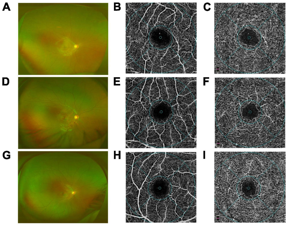 Frontiers | Retinal microvasculature observations of fellow eyes after ...