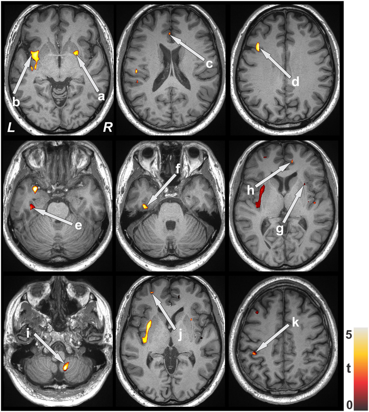 Frontiers | Functional comorbidities and brain tissue changes before ...