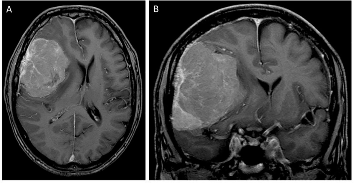 Frontiers | Case report: Use of 68Ga-DOTATATE-PET for treatment ...