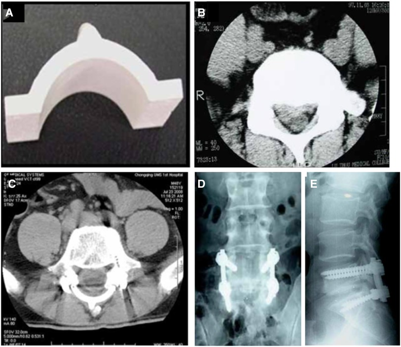 Frontiers | Artificial lamina after laminectomy: Progress, applications ...