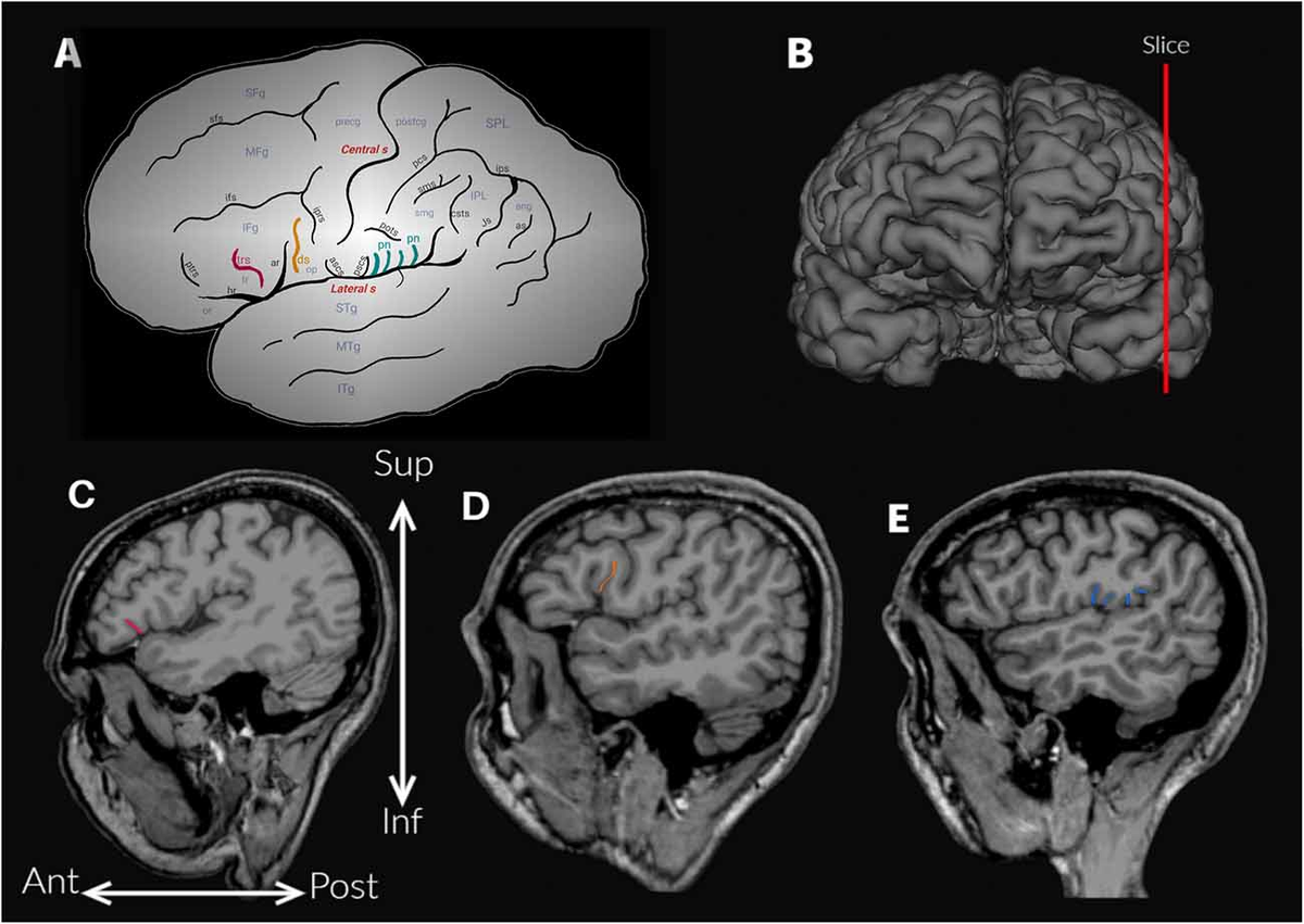 Frontiers | Influence of accessory sulci of the frontoparietal operculum on gray matter ...