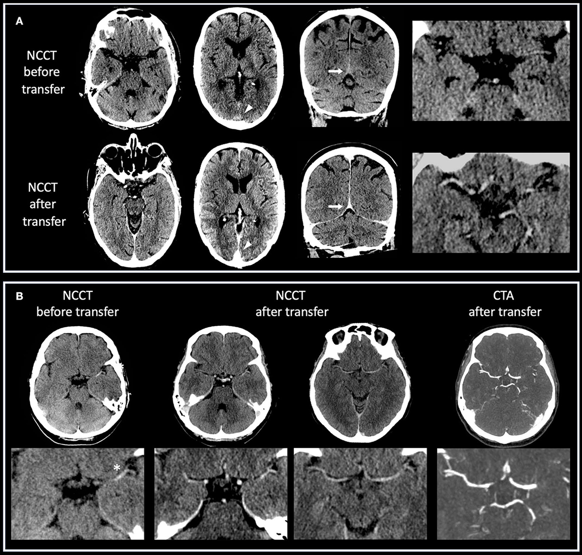 Frontiers | CT after interhospital transfer in acute ischemic stroke ...
