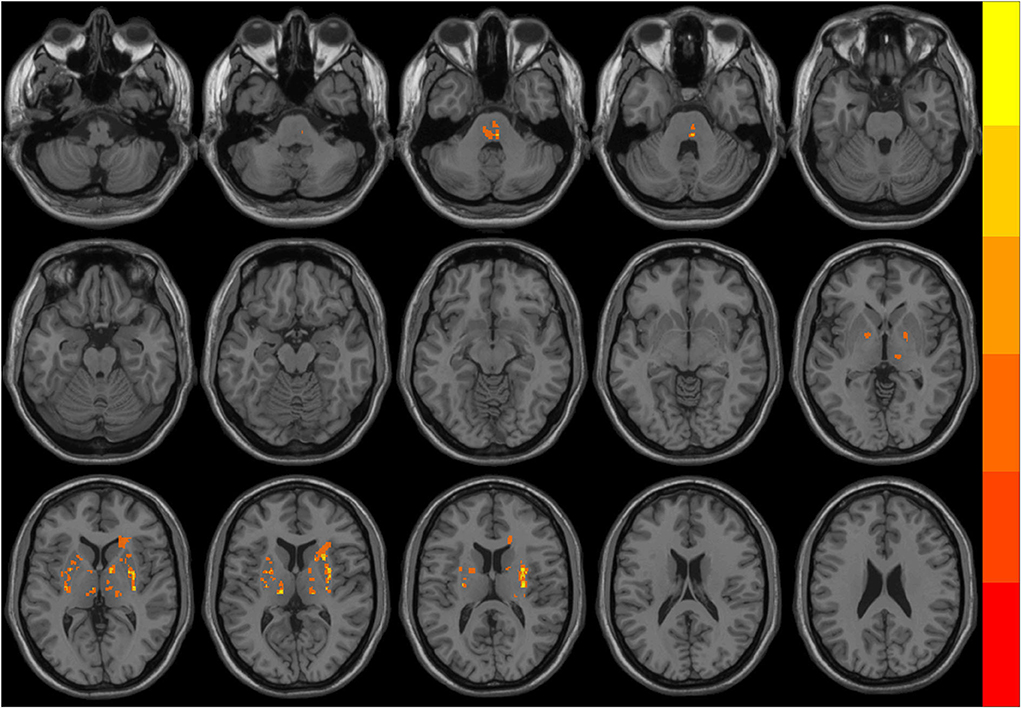 Frontiers | Regional brain dysfunction in insomnia after ischemic ...