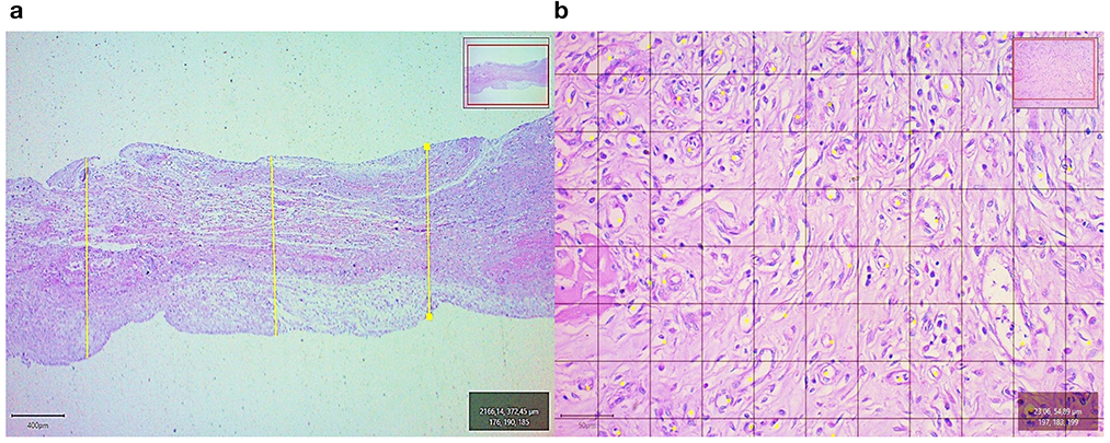 Frontiers | Induced membrane technique using bone cement with or ...