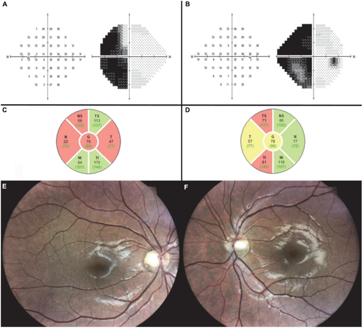 Frontiers | Simplifying the diagnosis of optic tract lesions