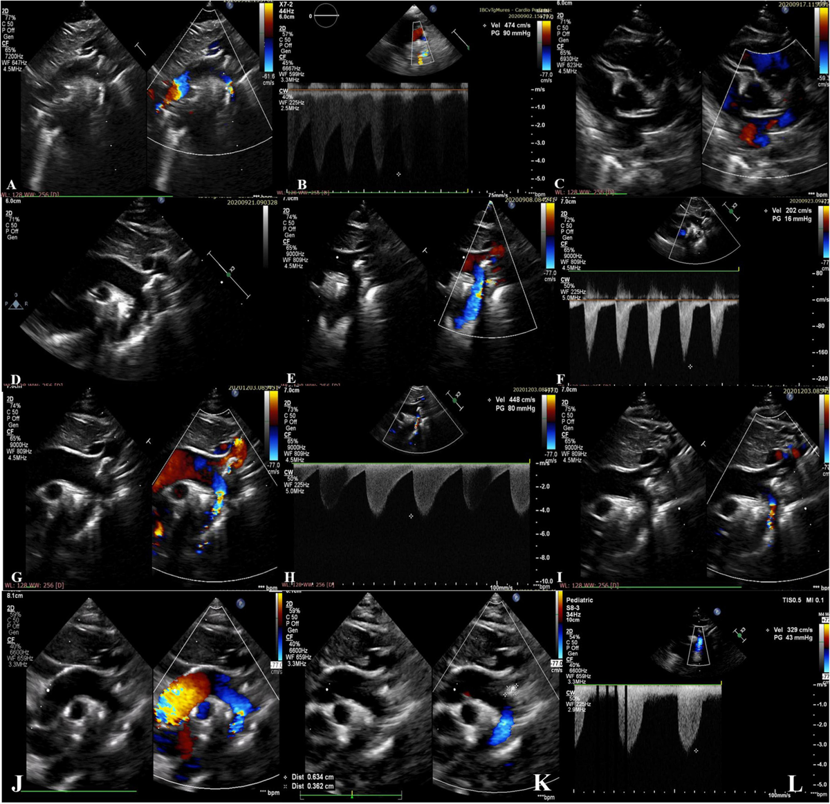 Frontiers | Severe early-onset manifestations of generalized arterial ...