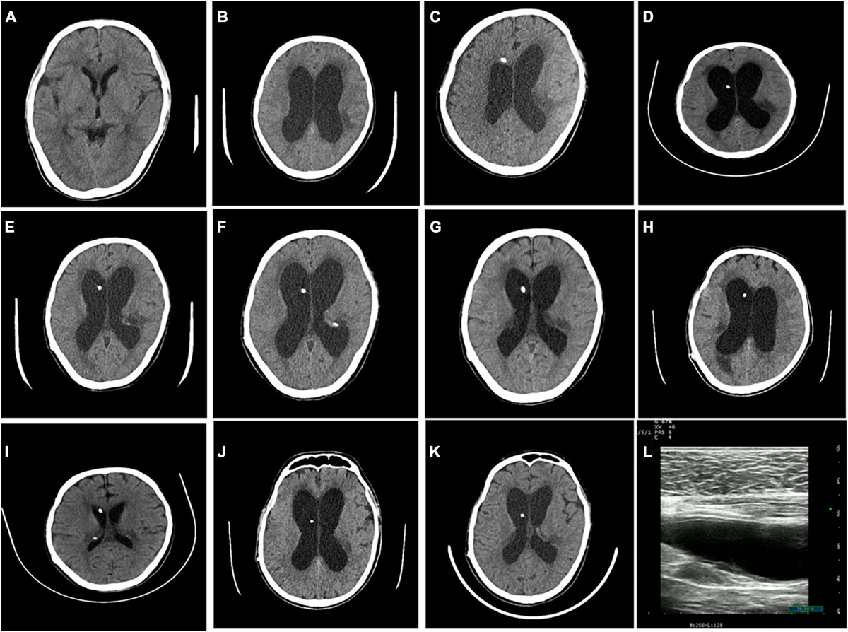 Frontiers | Management of long-term cryptococcal meningitis neoformans ...