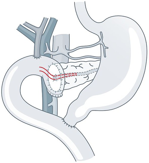 Frontiers | Preoperative risk assessment for postoperative pancreatic ...