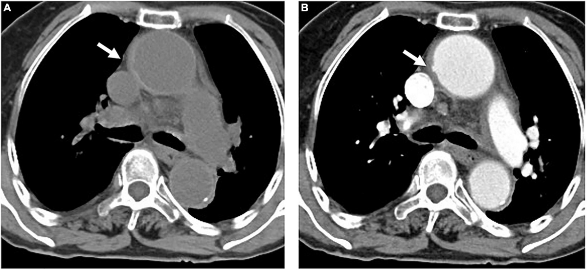 Frontiers | CT characteristics and clinical implications of acute type ...