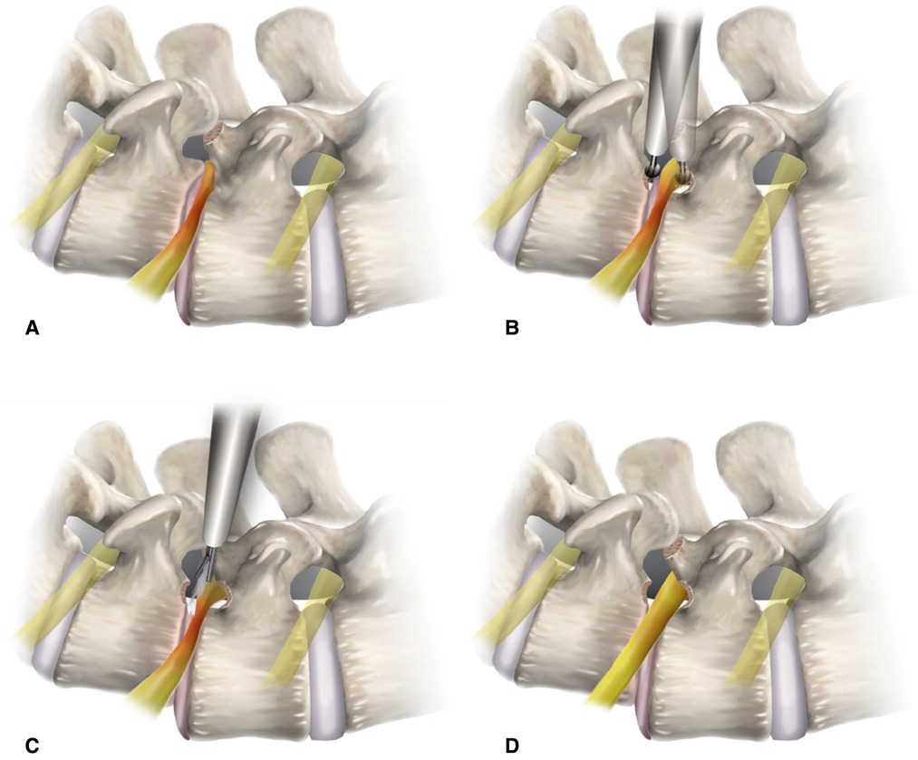 Frontiers | Endoscopic lumbar foraminotomy for foraminal stenosis in ...