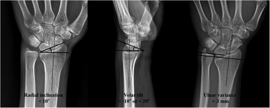 Frontiers | Forearm bone mineral density as a predictor of reduction ...