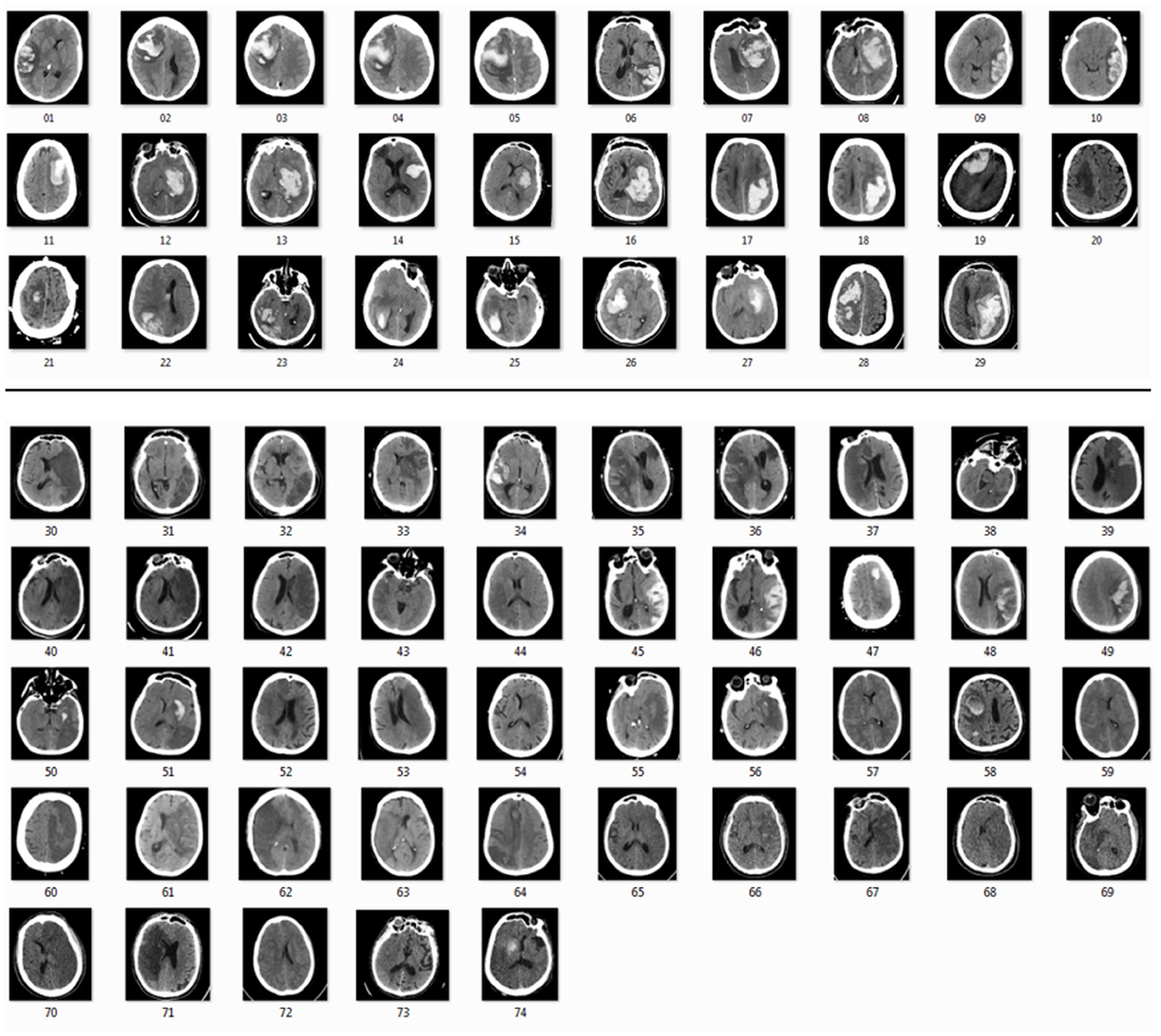 Frontiers | Quantitative pupillometry and radiographic markers of ...