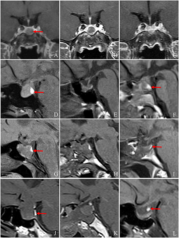 Frontiers | Pituitary stalk changes on magnetic resonance imaging ...
