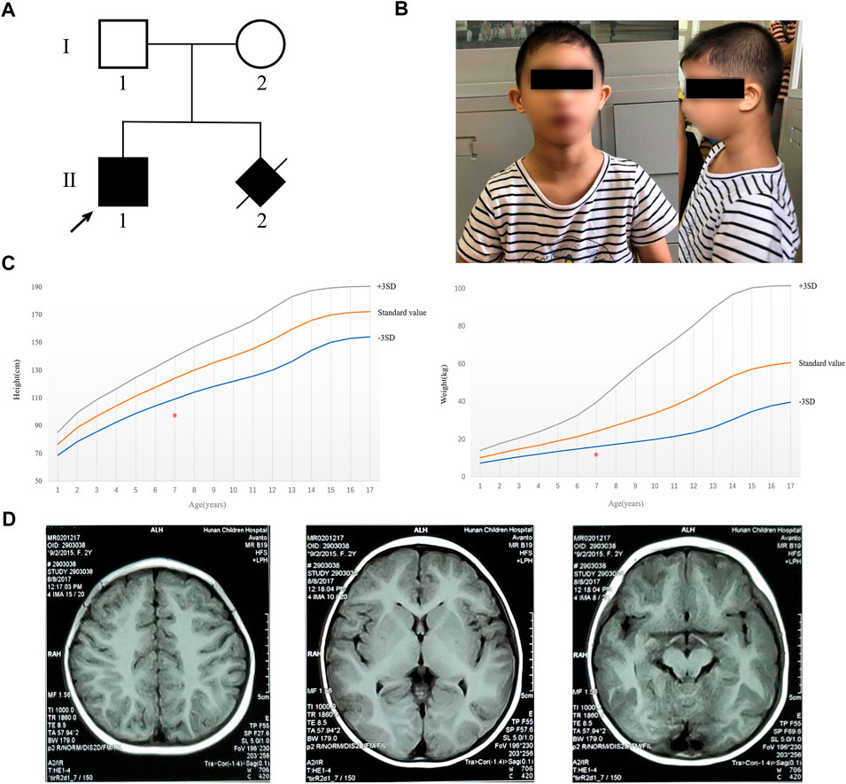 Frontiers | Two novel variants in CEP152 caused Seckel syndrome 5 in a ...