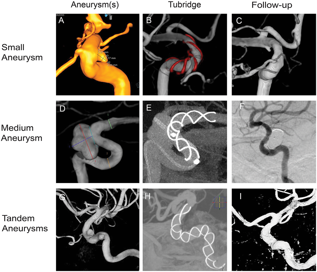 Frontiers | Tubridge flow diverter for the treatment of small and medium aneurysms