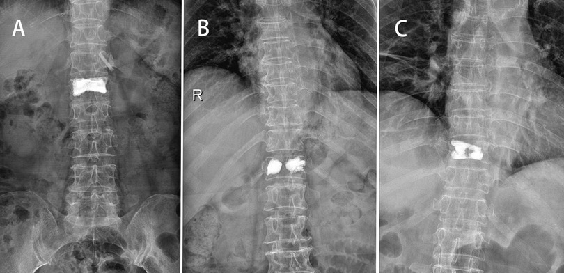 Frontiers | Effects of distribution of bone cement on clinical efficacy ...