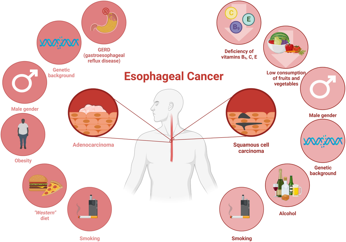 Frontiers Esophageal Cancer And Bacterial Part Of Gut Microbiota A Multidisciplinary Point