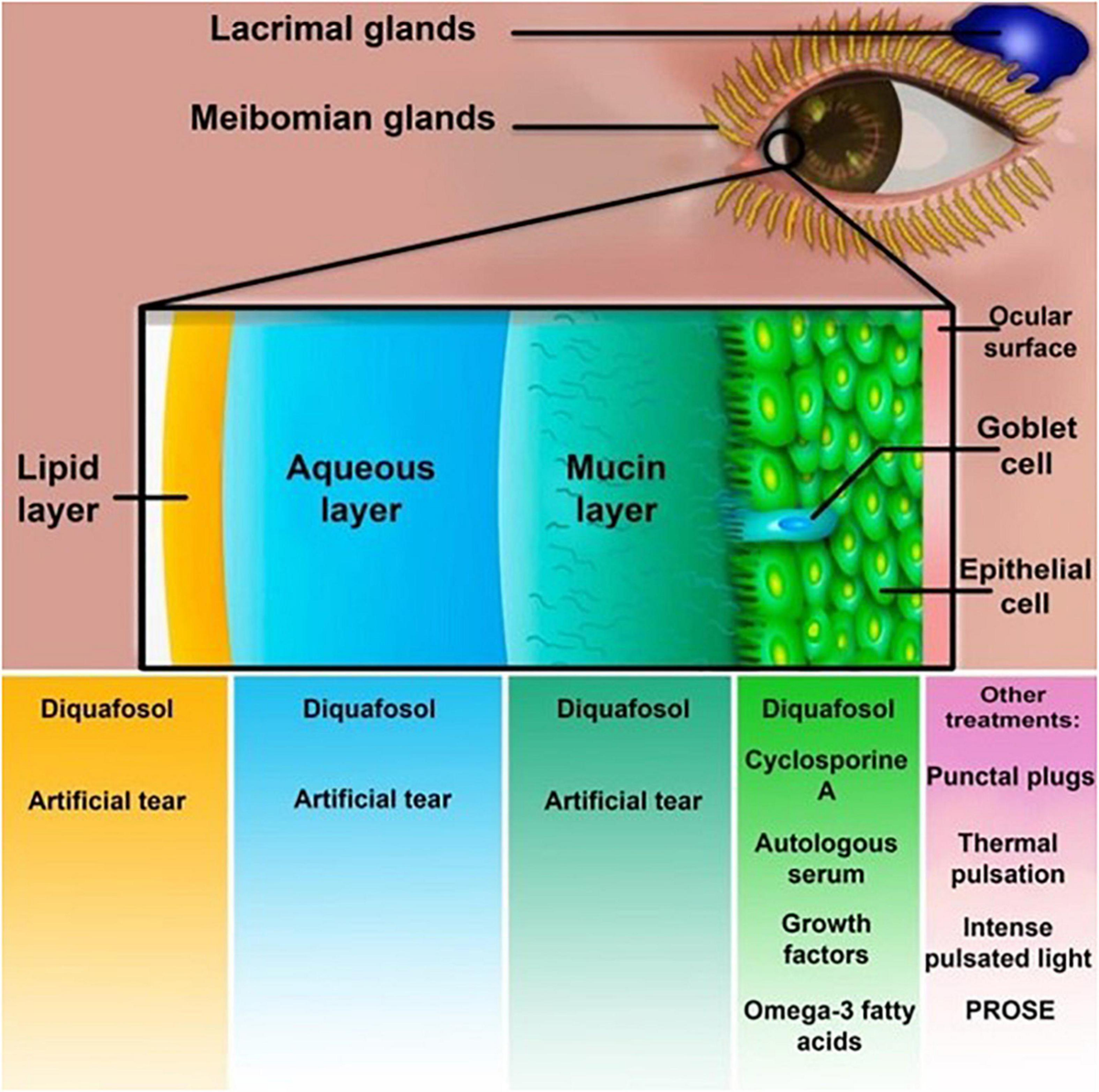 Frontiers | Post-LASIK dry eye disease: A comprehensive review of ...